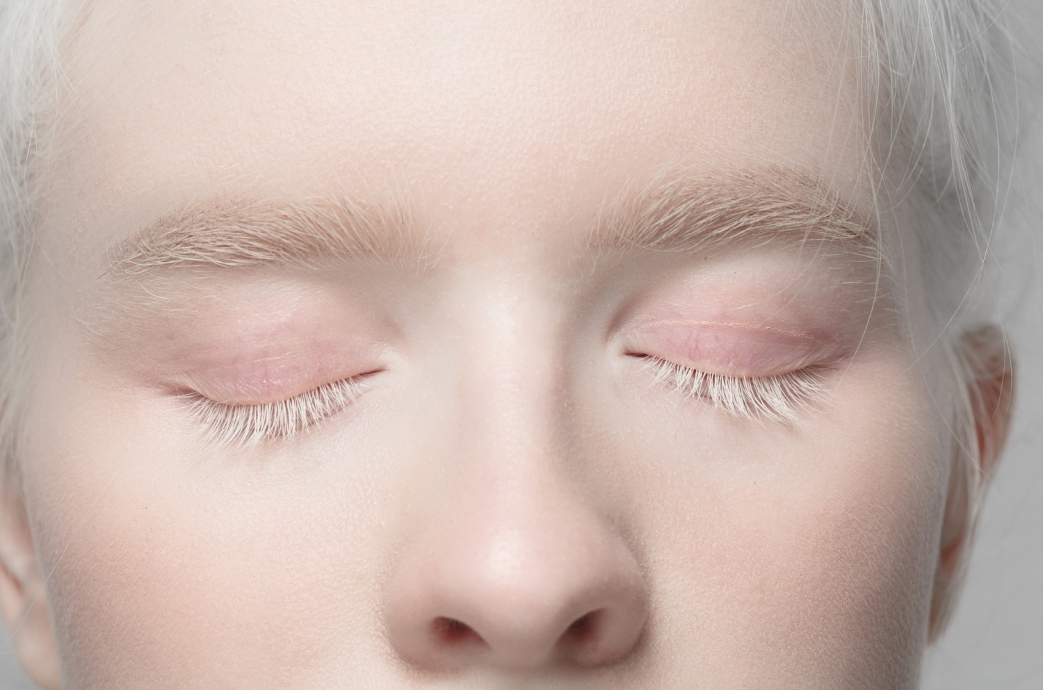 ALBINISMO: UNA CONDICIÓN GENÉTICA COMPLEJA - Lorgen