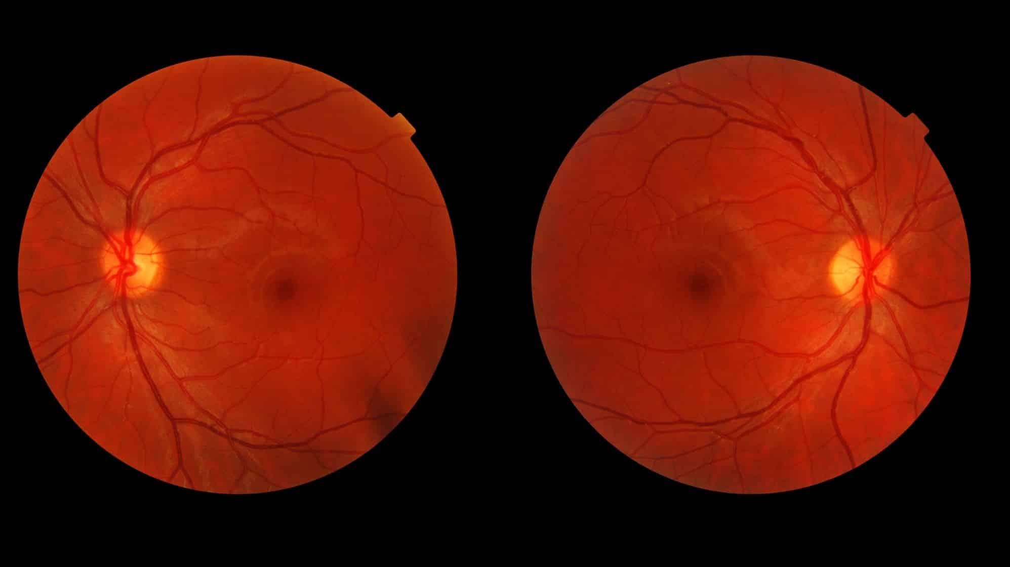 Amaurosis Congénita de Leber: Causa y Efecto - Lorgen